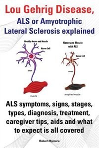 Lou Gehrig Disease, Als Or Amyotrophic Lateral Sclerosis Explained. Als ...