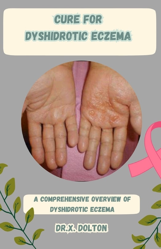 Cure for Dyshidrotic Eczema: A Comprehensive Overview of Dyshidrotic ...