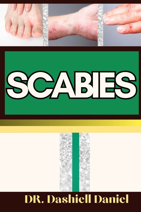 Scabies: Expert Guide To Understanding Scabies Causes, Symptoms, Preventing, Treatment For ...