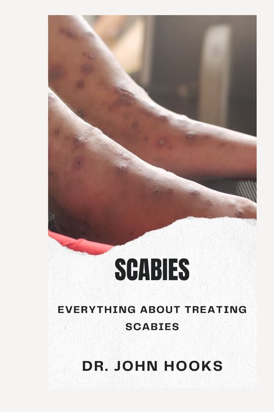 Scabies: Everything about Treating Scabies | Indigo